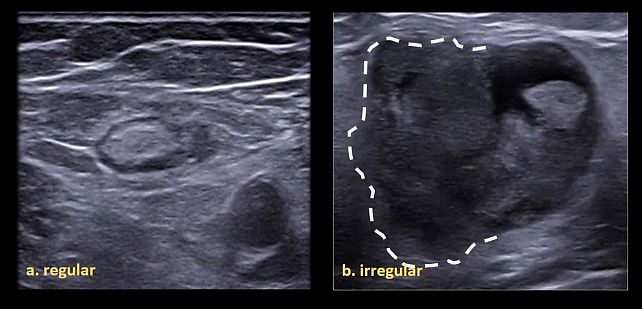 Inguinal Abscess Ultrasound